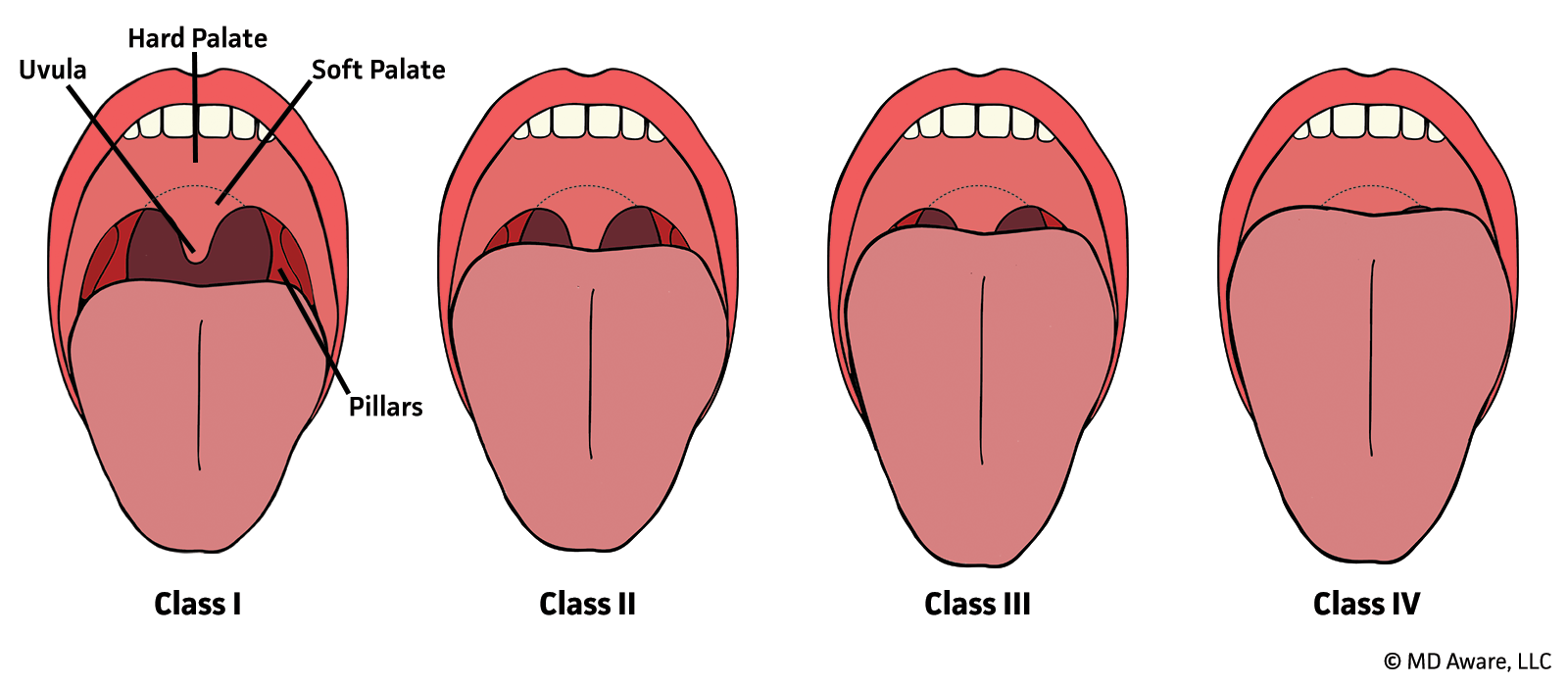 Calculadora Médica | Classificação de Mallampati Modificada